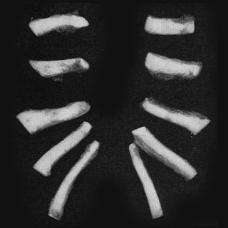 Cirurgia de Ravitch – Não usar essa técnica - Pectus