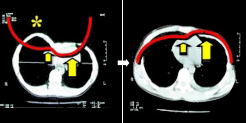 Como fazemos a "Cirurgia de Park" - Pectus