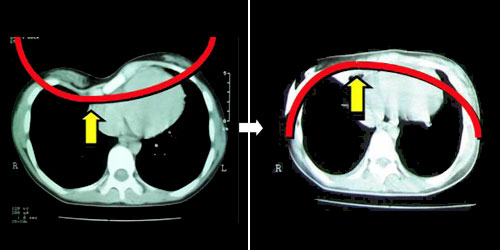 Como fazemos a "Cirurgia de Park" - Pectus